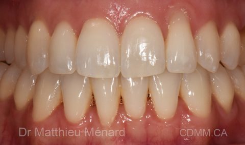 Invisalign - Centre Dentaire Matthieu Ménard