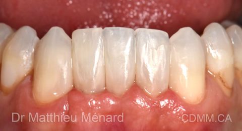 Triangle noir - Bioclear - Centre Dentaire Matthieu Ménard