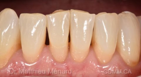 Black triangle - Bioclear - Centre Dentaire Matthieu Ménard